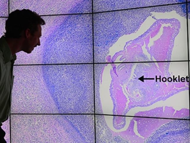 Parasitic (cysticercus) granulomatous abscess 20X | Virtual Microscopy